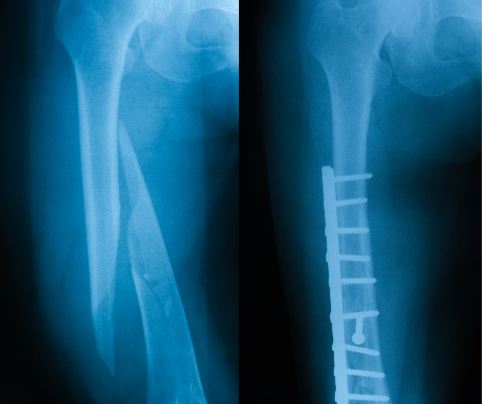 Understanding the Causes and Consequences of Bone Fractures