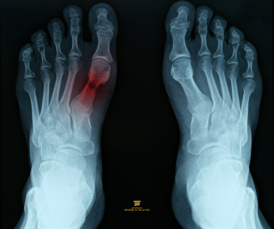 A Closer Look at Bone Fracture Injuries